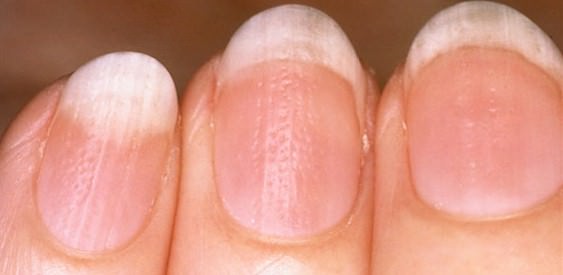 Doenças das Unhas - confira os sintomas e como tratar cada caso ...